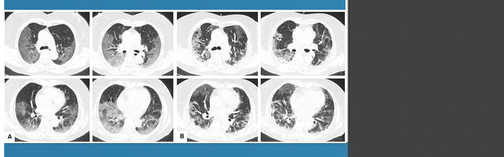 Six Visual Rating Scales as A Biomarker for Monitoring Atrophied Brain Volume in Parkinson’s Disease
