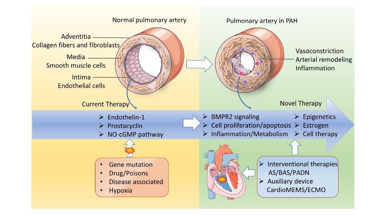 Pathological Mechanisms and Potential Therapeutic Targets of Pulmonary ...